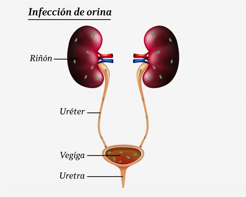 Infección urinaria - Dra. Teresa Aznar